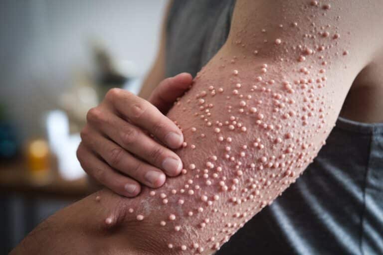 Papules : causes et traitements en dermatologie