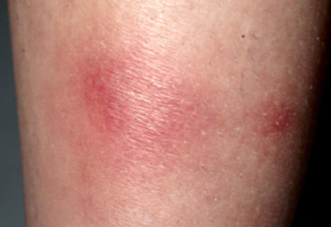 Érythème noueux : diagnostic, causes et traitements à connaître